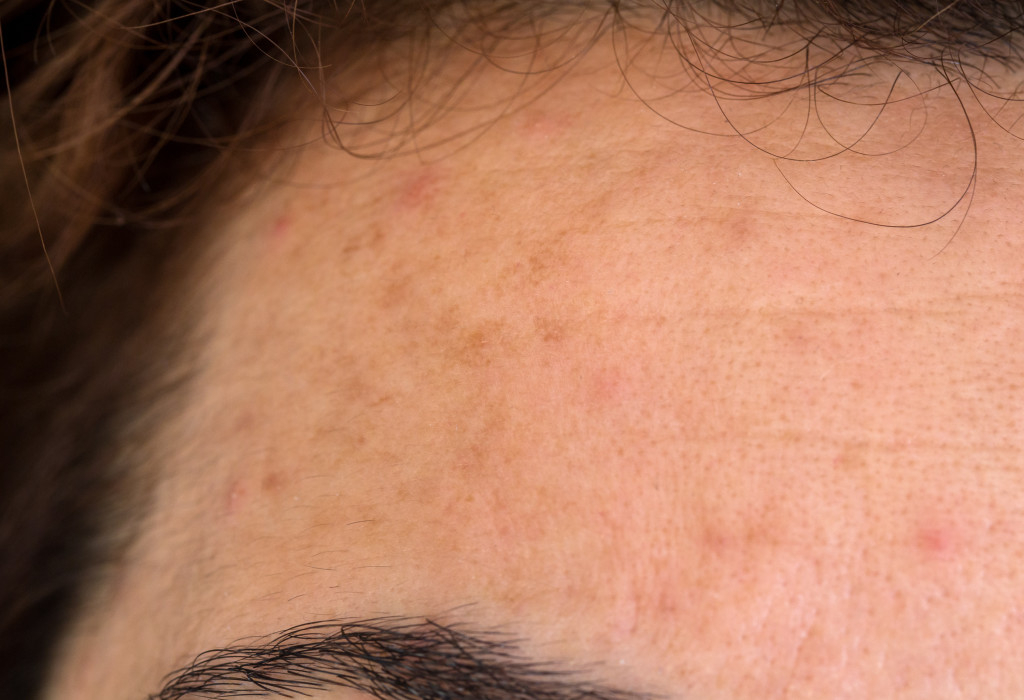What is Hyperpigmentation? | Personalized Skin Care inc